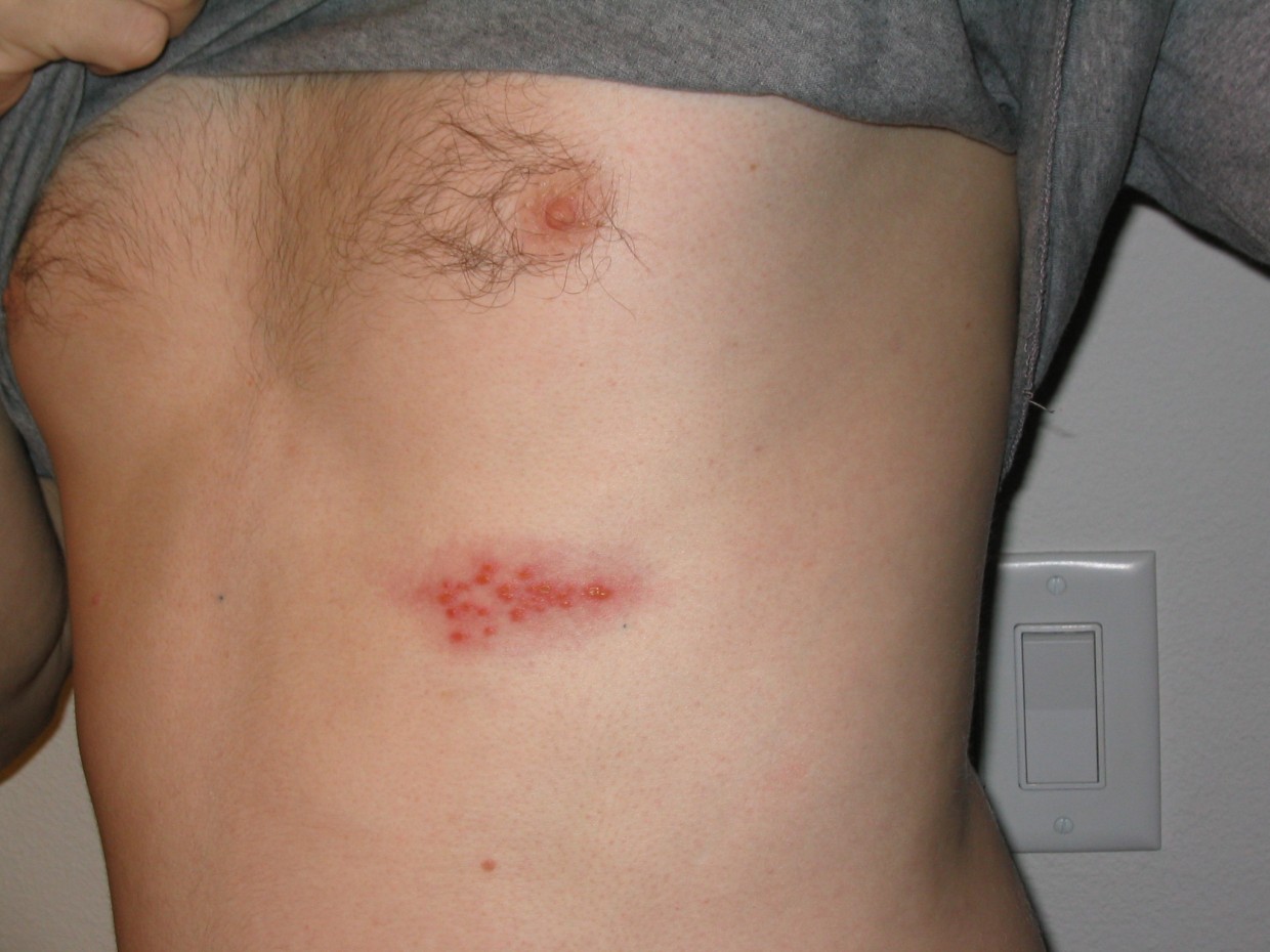 Oral Ulcers Shingles