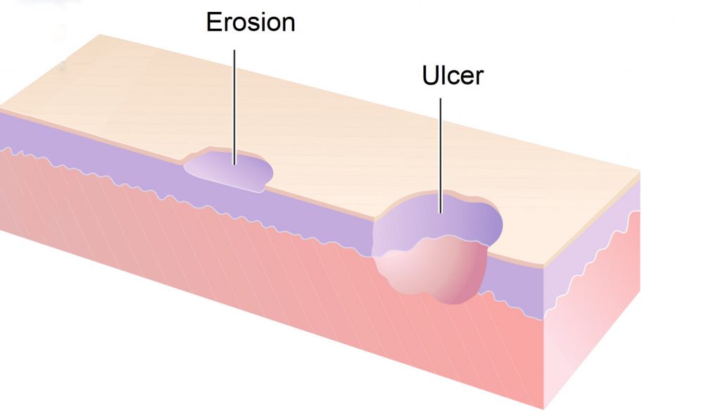 ulcers - OziDent