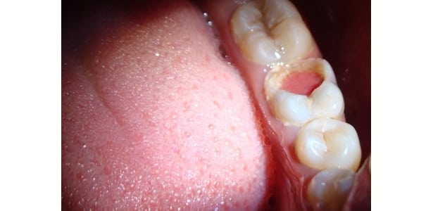 Fleshy Pulp - OziDent