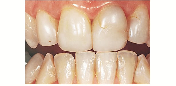 Failure of Dental Restorations