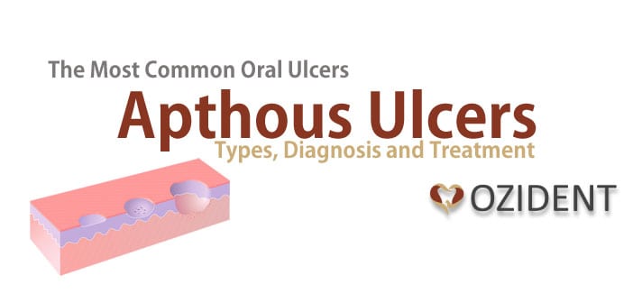 Oral Ulcers - Apthous Ulcers