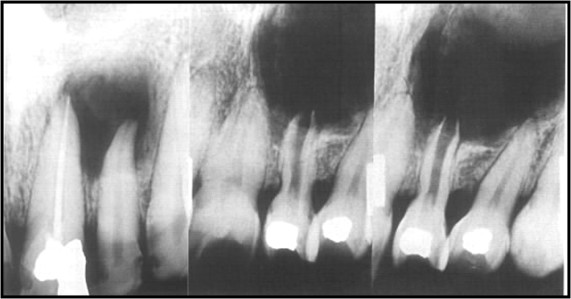 radicualar Cyst - OziDent