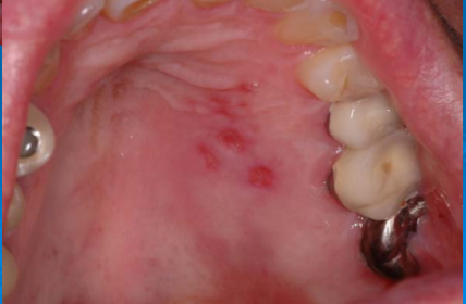 recurrent_intraoral_herpes1333814700309 - OziDent