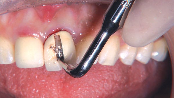 Removal of Fixed Prostheses