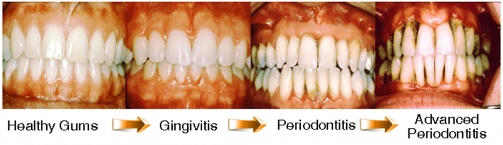 Gingivitis-Progression - OziDent